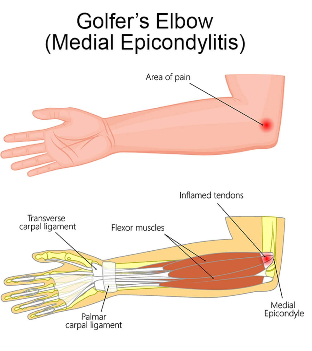 Kecederaan Tendon: Punca, Simptom dan Rawatan Fisioterapi